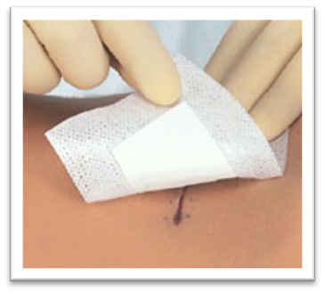 5 Types of Wound Dressing and Their Functions
